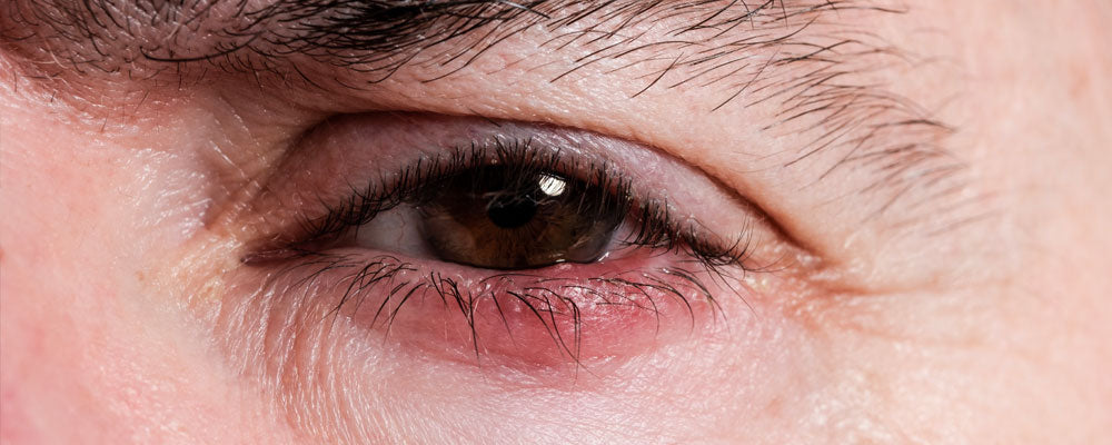 Meibomian gland dysfunction (MGD) - the commonest contributor to dry e ...